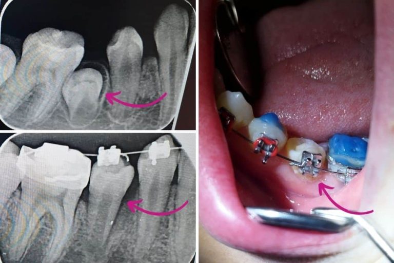 Surgical exposure of impacted teeth | Blog || Dr Veselinovic